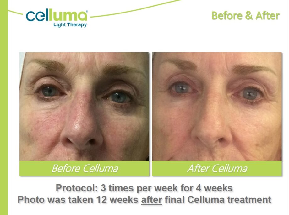 Celluma Pro – Classic Beauty