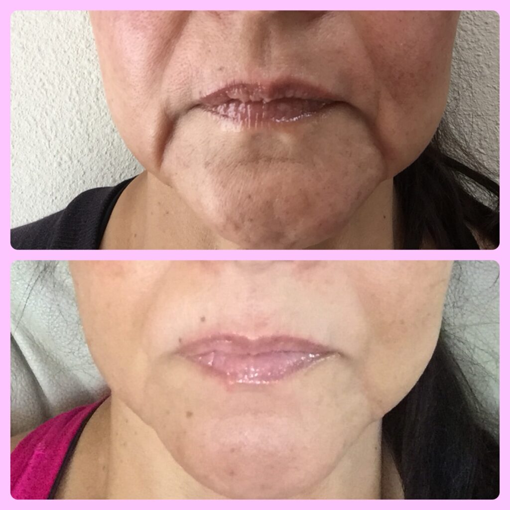 Procell Micro-Channeling – Classic Beauty